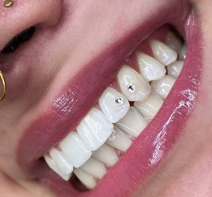 Smile Insight - Teeth Whitening